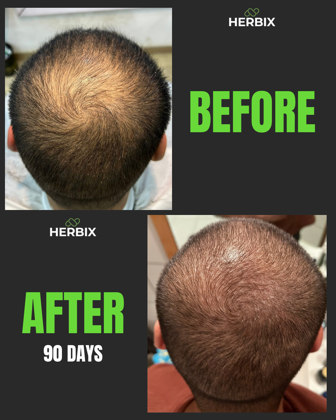 DHT Blocker (Hairloss) – Herbix