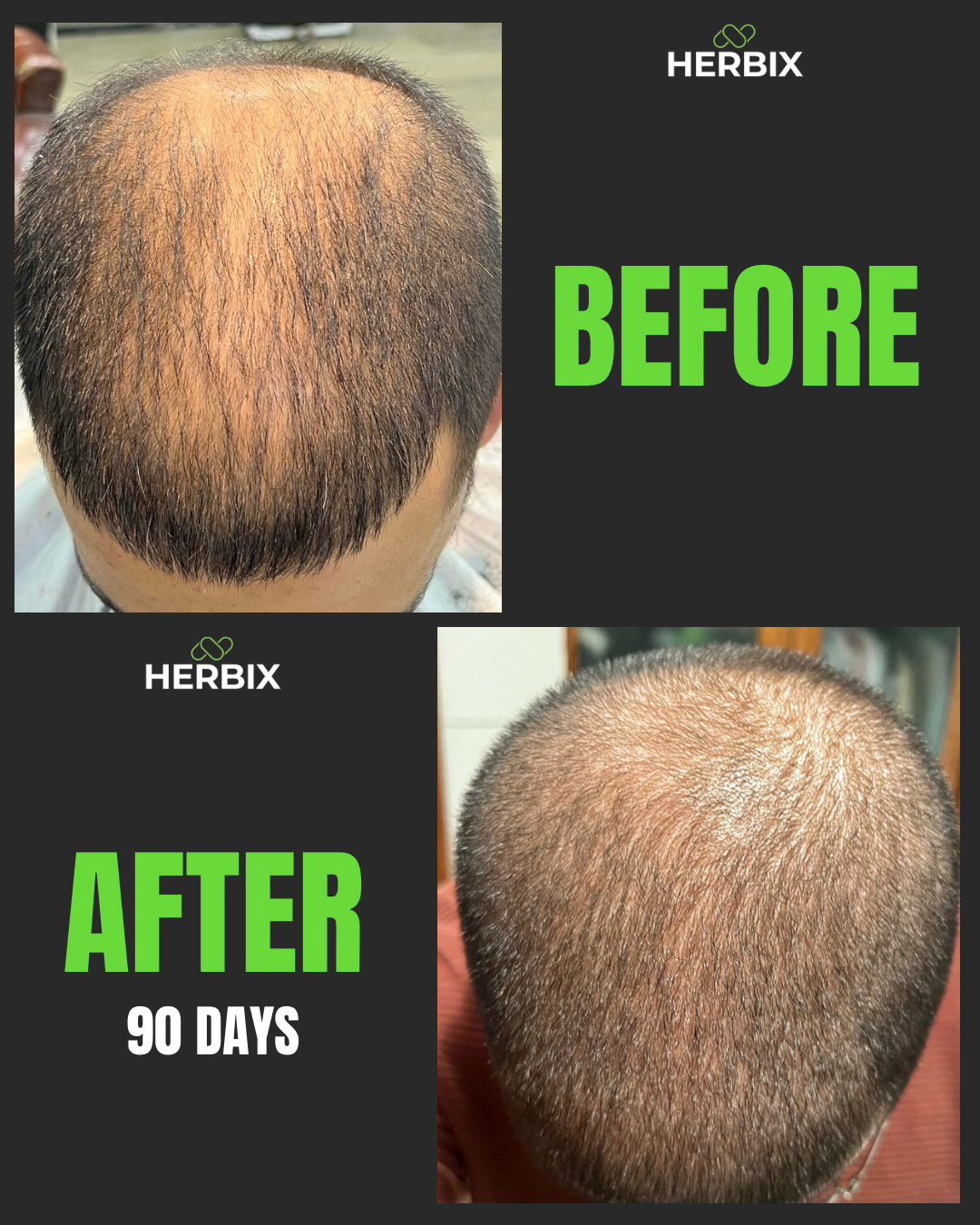 DHT Blocker (Hairloss) – Herbix